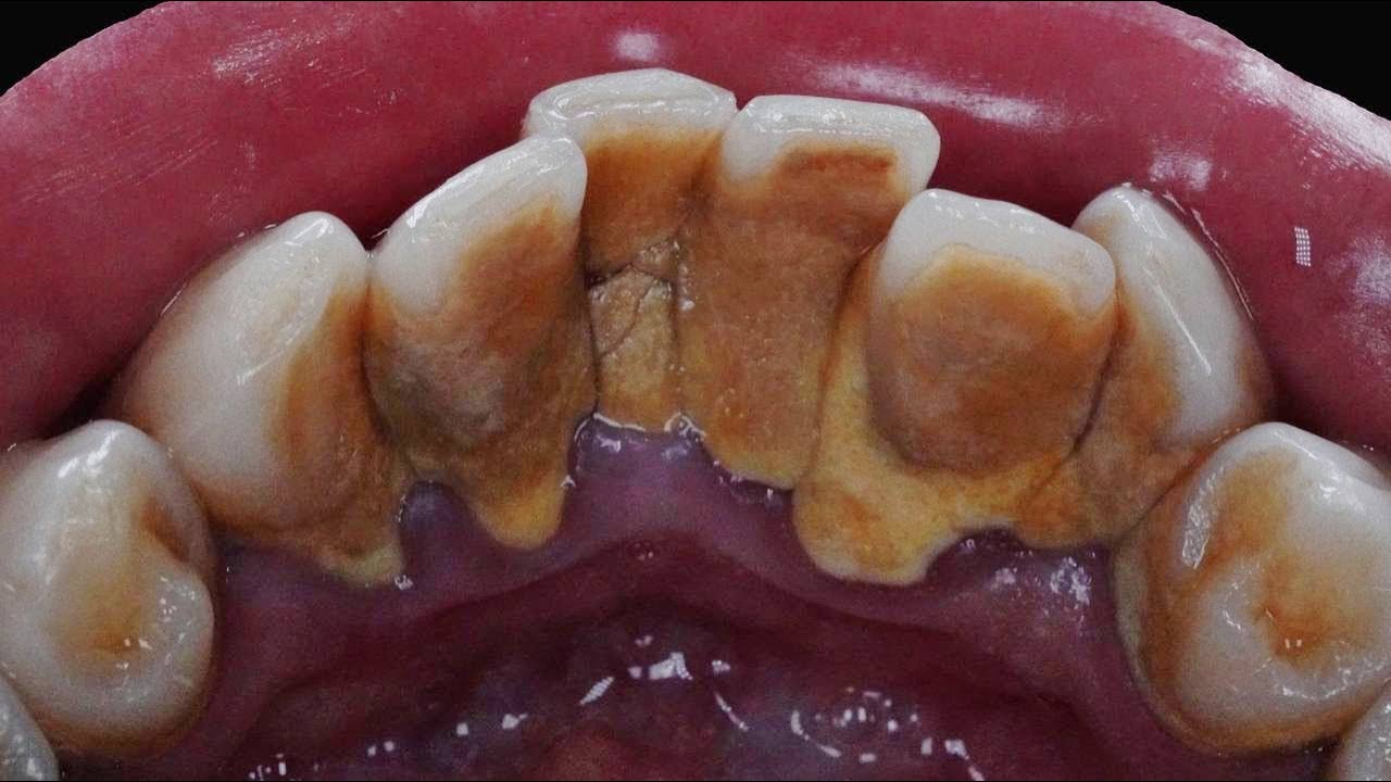 32 yo. Male's Teeth | Calculus | Karang Gigi | Dentist | Dokter Gigi ...