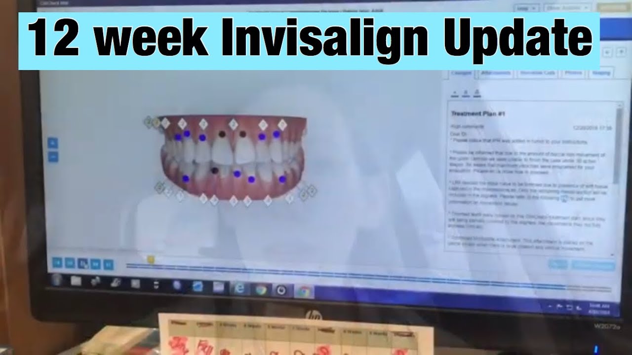 12 week Invisalign update / progress pictures - YouTube