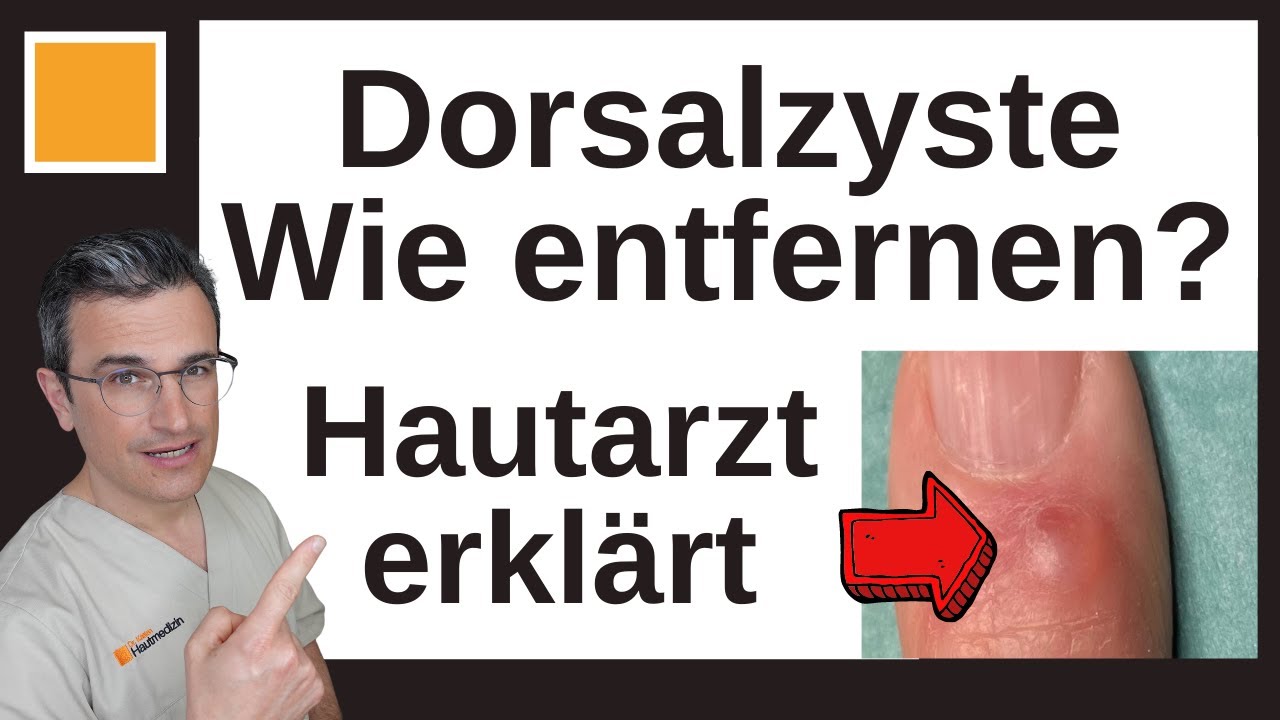 Mukoide Dorsalzyste: OP oder andere Therapie?| Dr. Kasten Hautmedizin ...