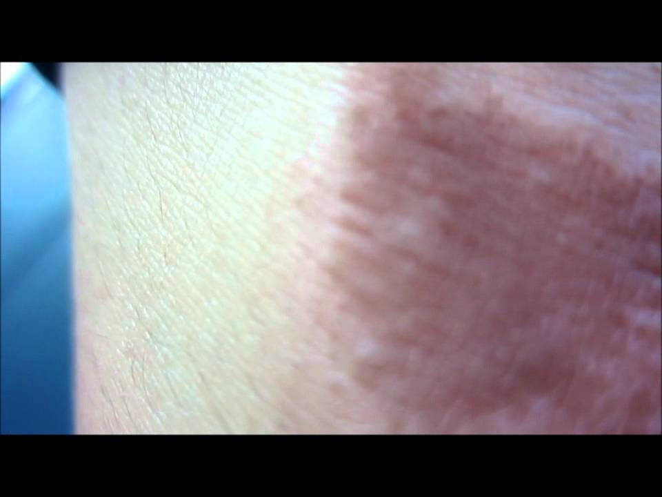 Scars from the Salt and Ice Challenge - YouTube