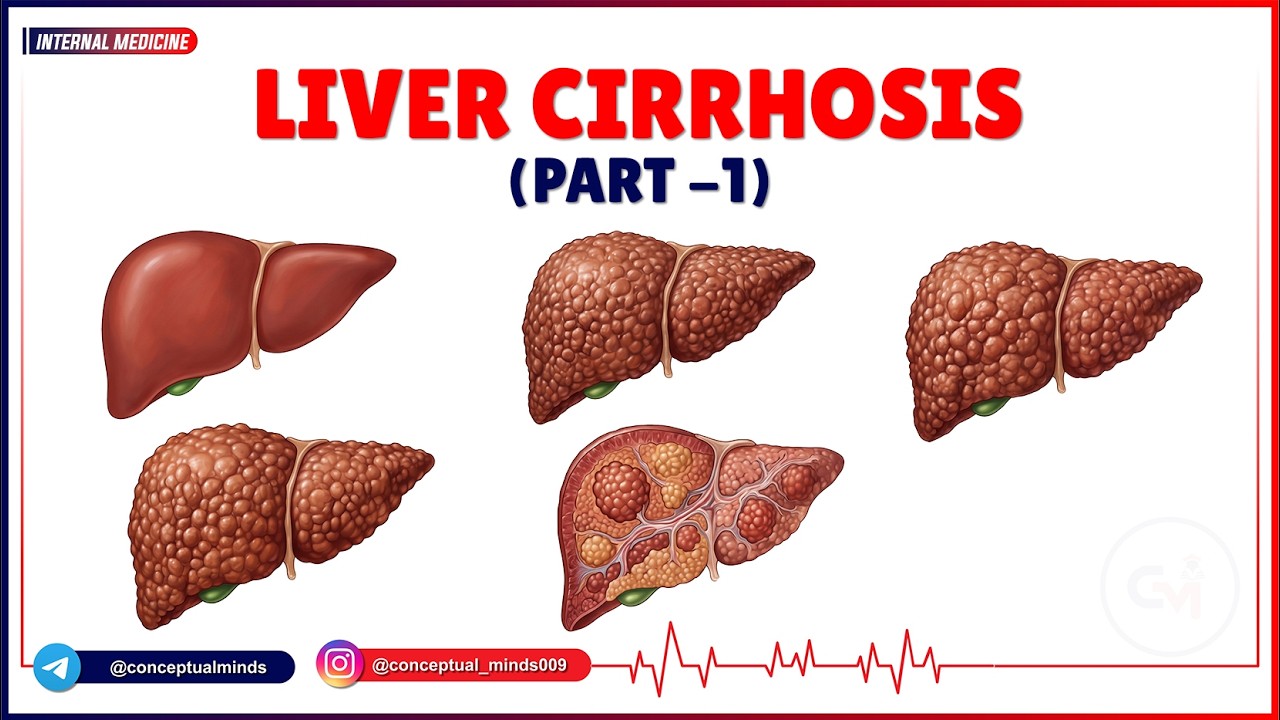 Liver Cirrhosis (Part 1): Pathogenesis & Clinical Features - Internal ...