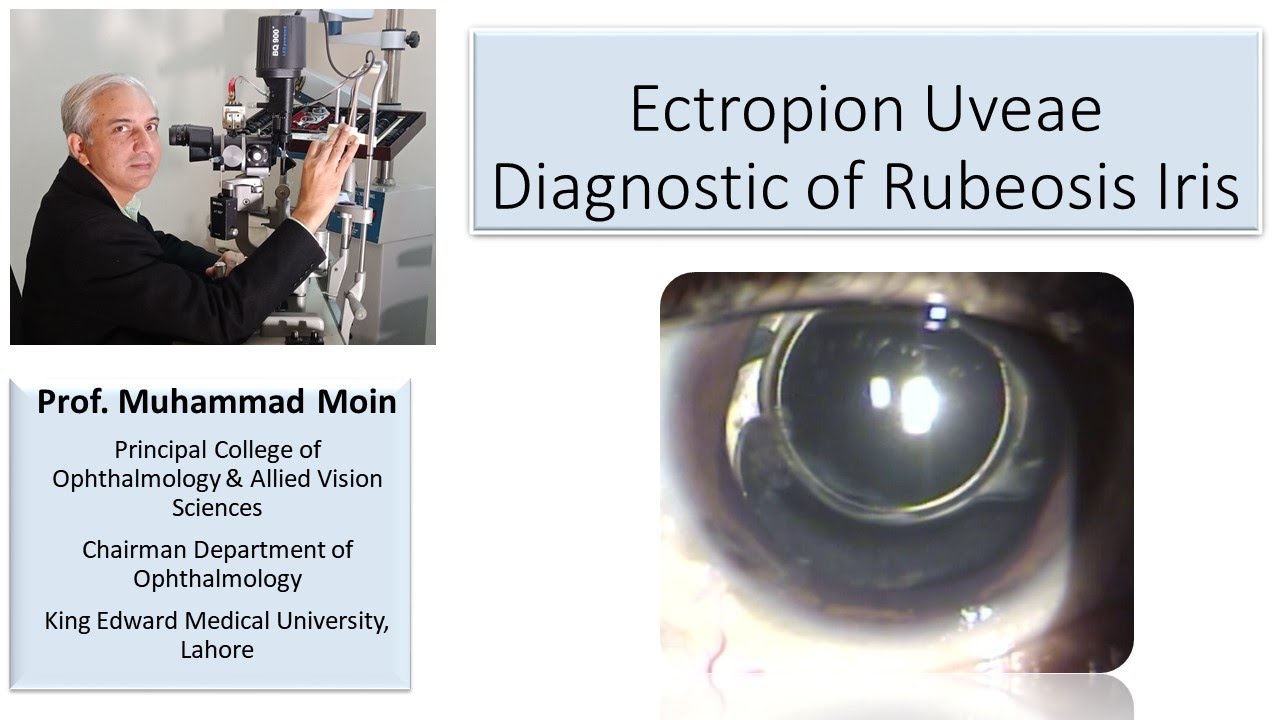 Ectropion Uveae; Diagnostic Feature of Rubeotic Glaucoma - YouTube