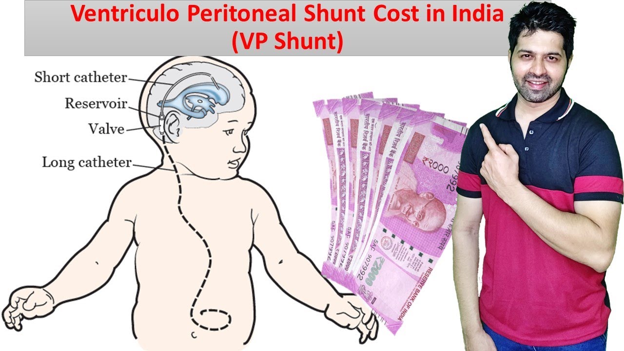 cost of Ventriculo Peritoneal Shunt (vp shunt) operation in India. In ...