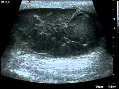 ABSCESO ESCROTAL - CEUS-ID - YouTube