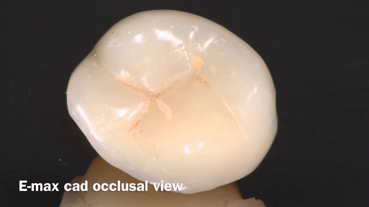 endocrown, restoration of grossly decayed tooth - YouTube