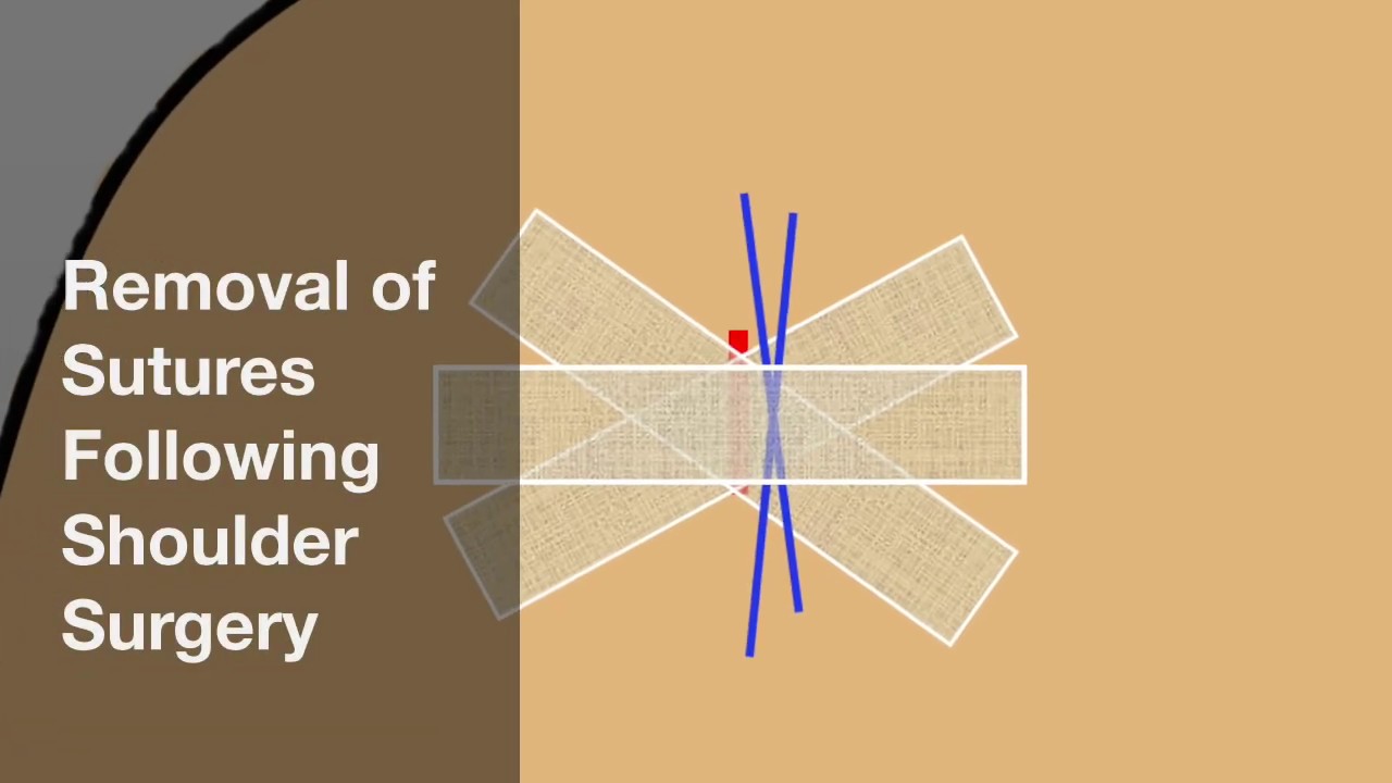 Suture Removal - YouTube