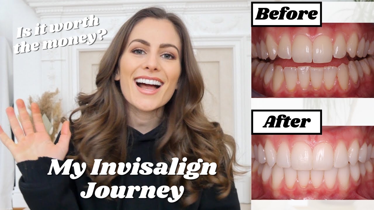 INVISALIGN JOURNEY | Before & After - Is it worth it? - YouTube