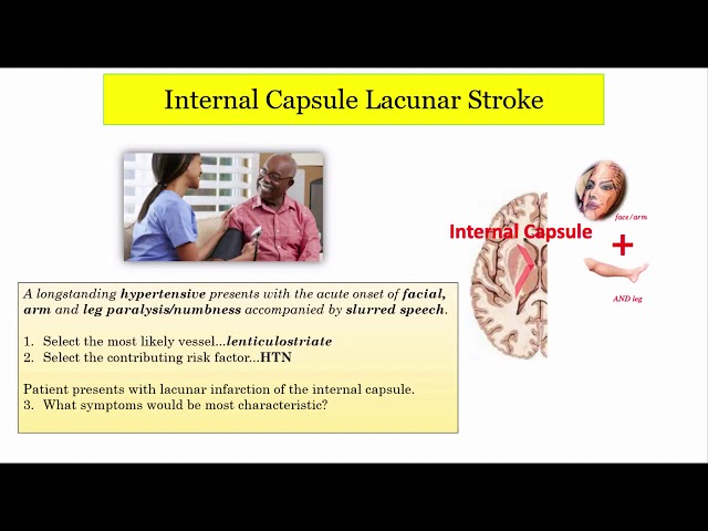 Lacunar Stroke Syndromes