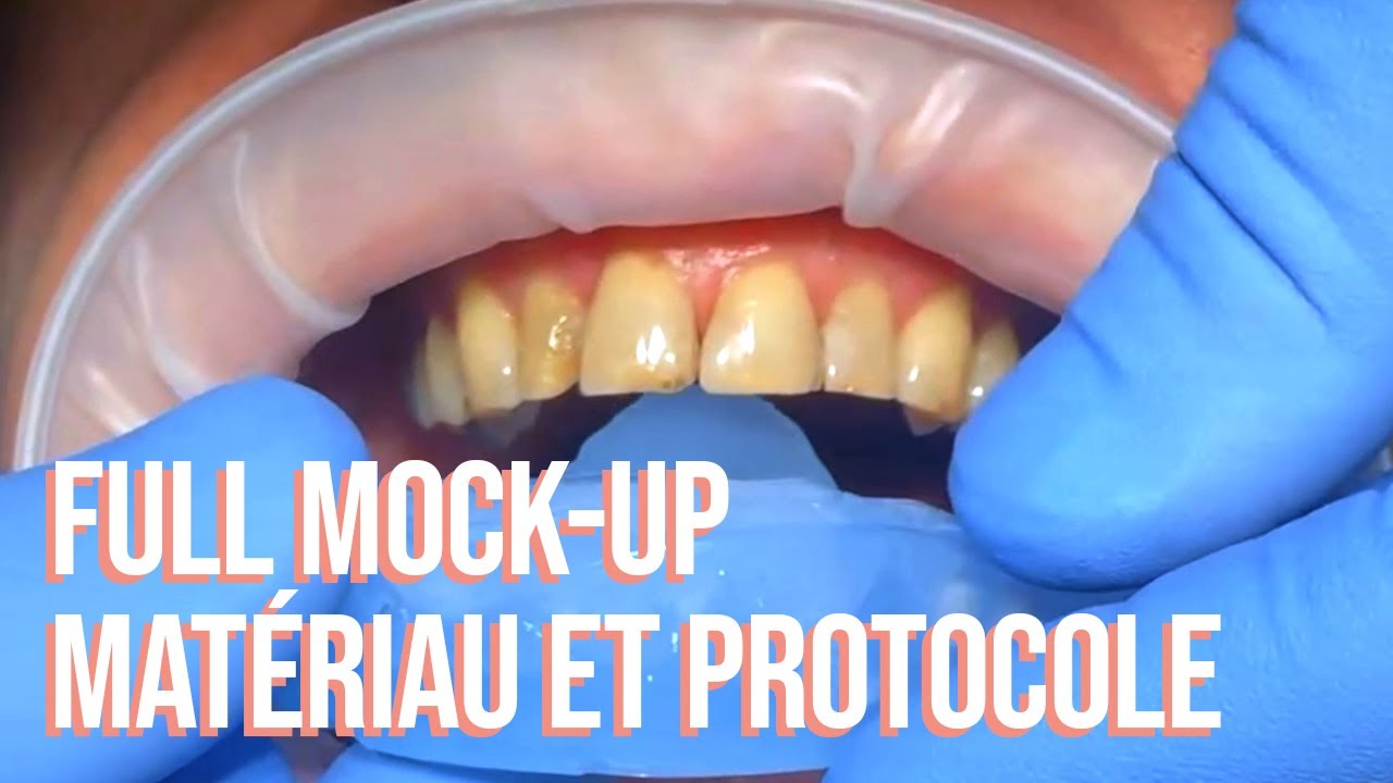 Full mock-up : quel matériau, quel protocole ? / Full mock-up: which ...