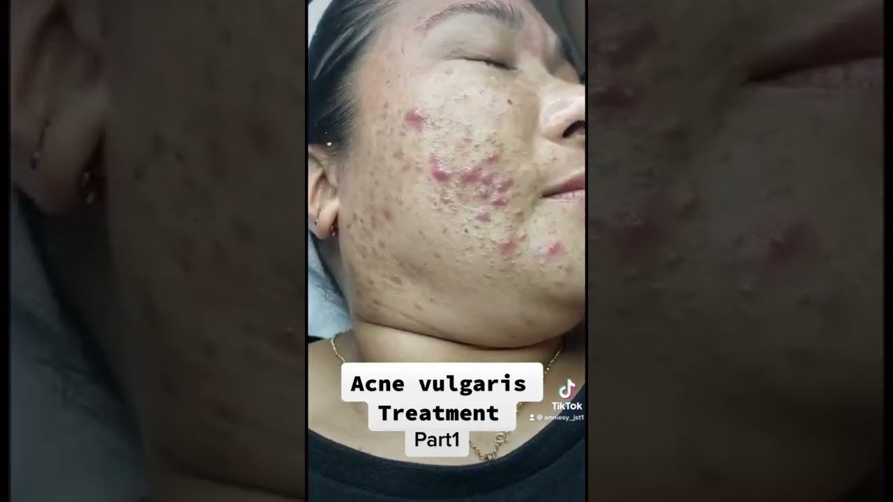 The acne treatment & procedure part 1 - YouTube