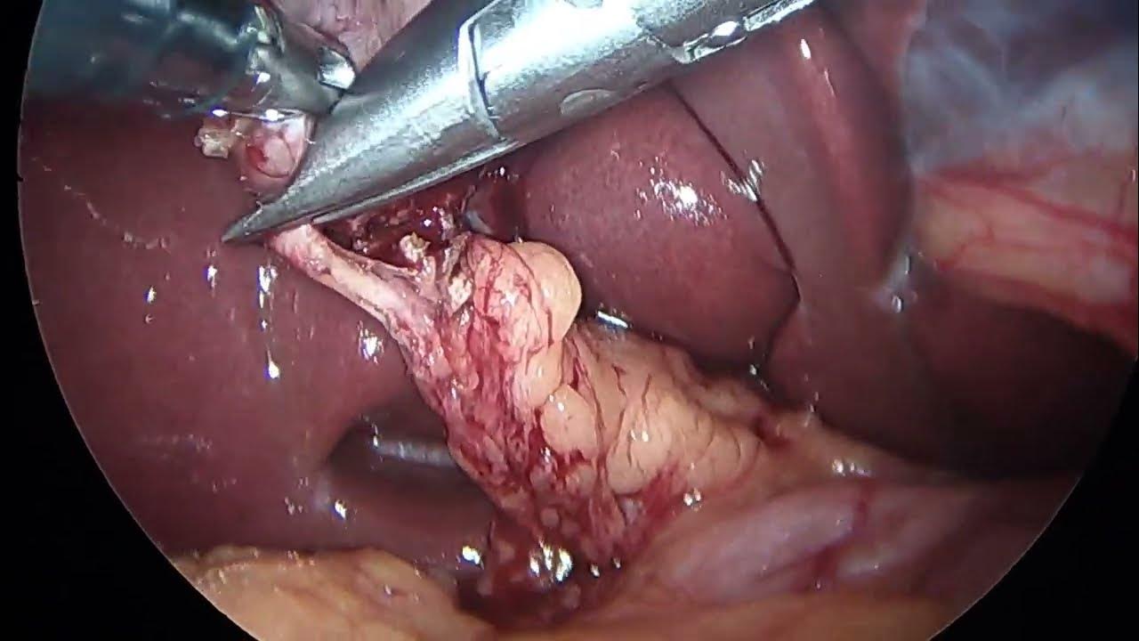 Colecistectomia laparoscópica/ Laparoscopic cholecystectomy - YouTube