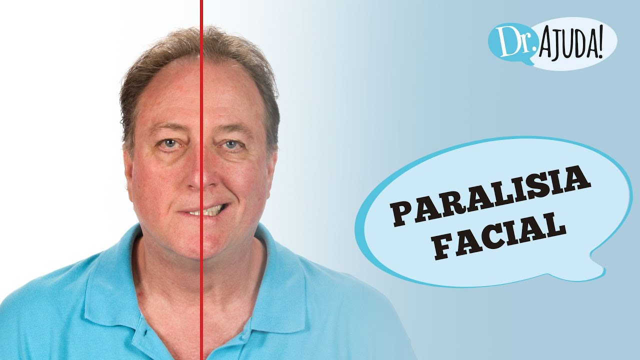 PARALISIA FACIAL: O QUE É, SINTOMAS, DIAGNÓSTICO, CAUSAS E TRATAMENTO ...