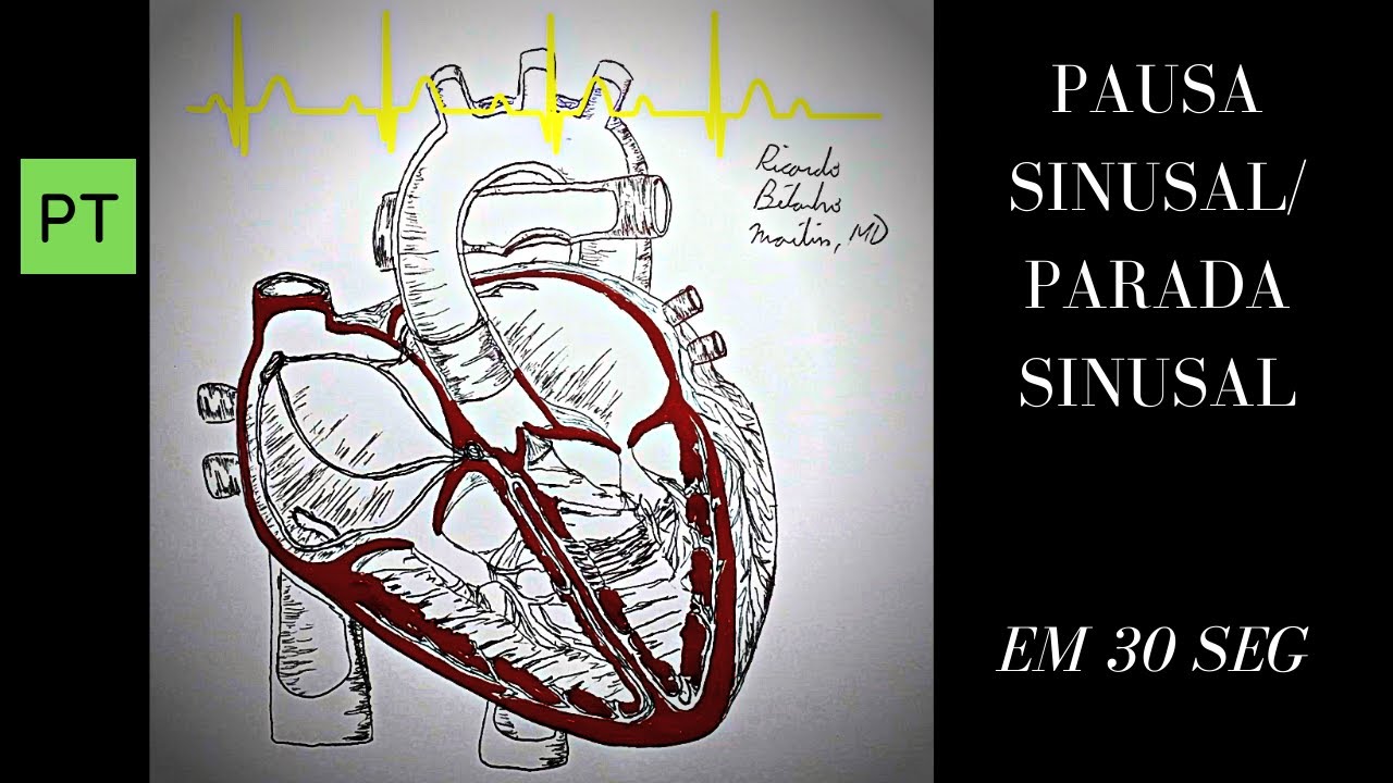 Arritmias (Animação cardíaca e ECG) - Pausa Sinusal / Parada Sinusal # ...