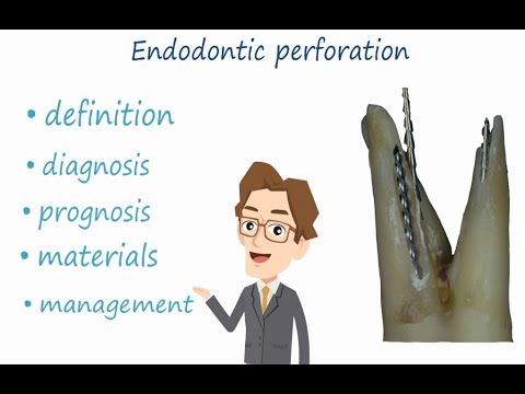 The Ultimate Guide to Endodontic Perforation Management: What every ...