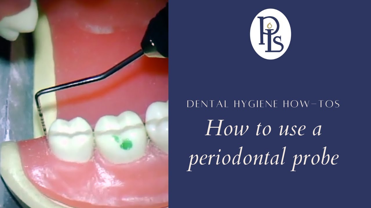 How to use a periodontal probe on a dental patient - YouTube