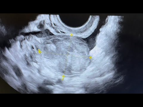 Ruptured corpus luteum cyst. UPT -ve. Today 25th day of cycle ...