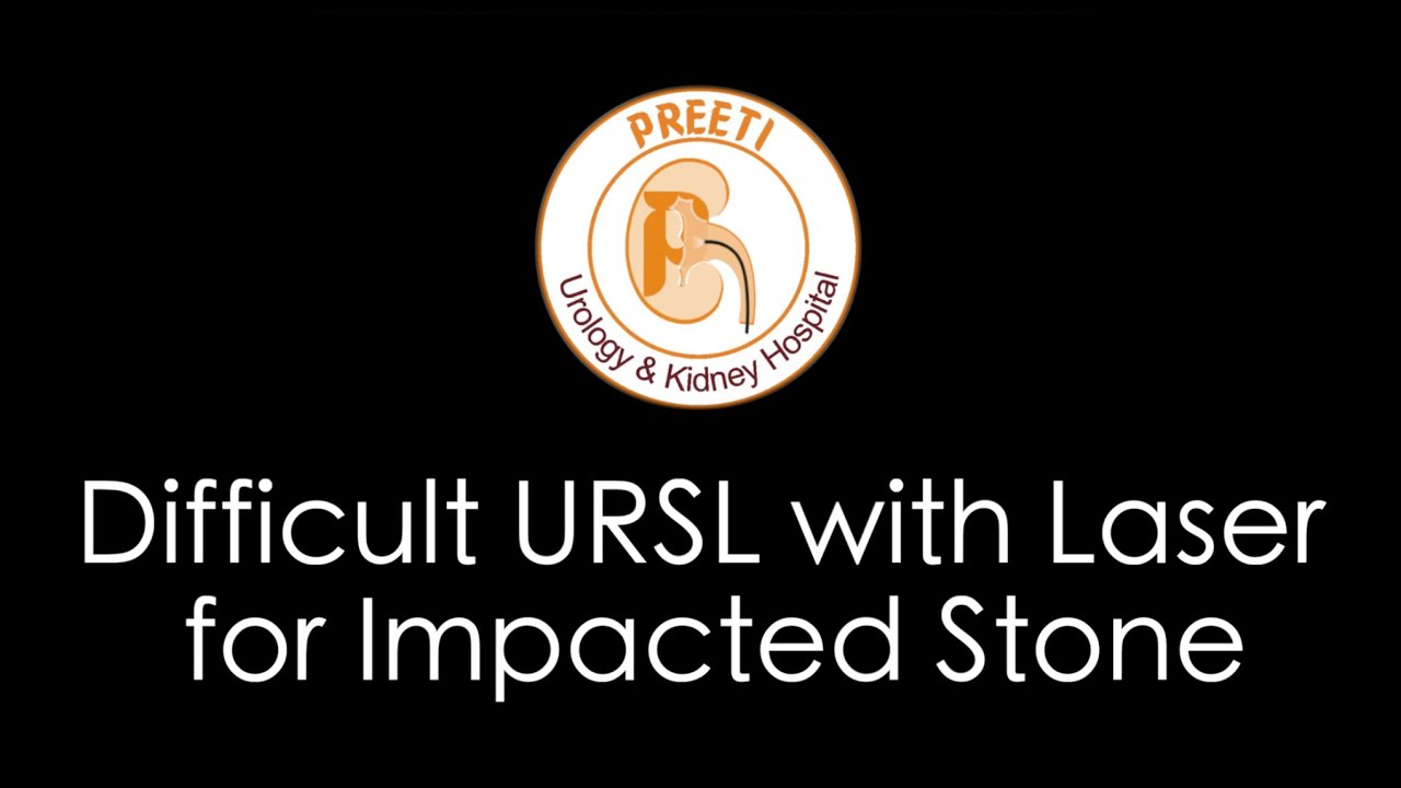 Difficult URSL with Laser for Impacted Stone - YouTube