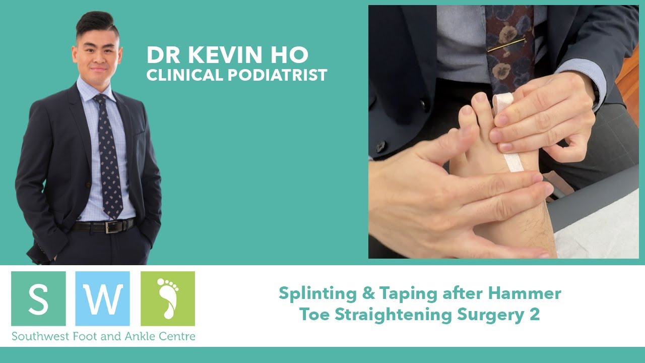 Splinting & Taping after Hammer Toe Straightening Surgery 2 - YouTube