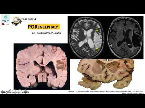 Porencephaly versus Schizencephaly (1/2) - YouTube