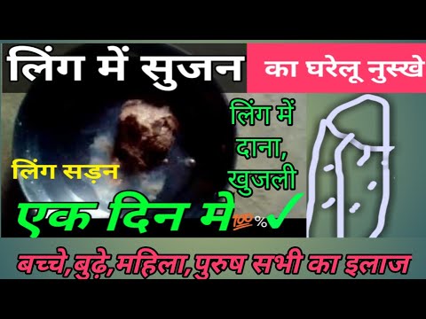 Ling me dane एक दिन में ठीक|लिंग में गर्मी सुजन से तुरंत राहत पाएं|ling ...