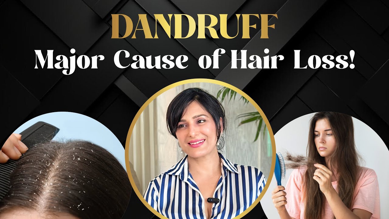 Dandruff: Major Cause of Hair Loss | Dandruff and Hair Loss Connection ...