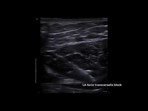 Rectus sheath block Ultrasound guided - YouTube