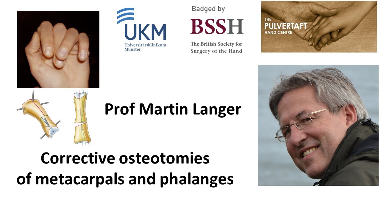 Corrective osteotomies of the metacarpal and phalanges by Prof Martin ...