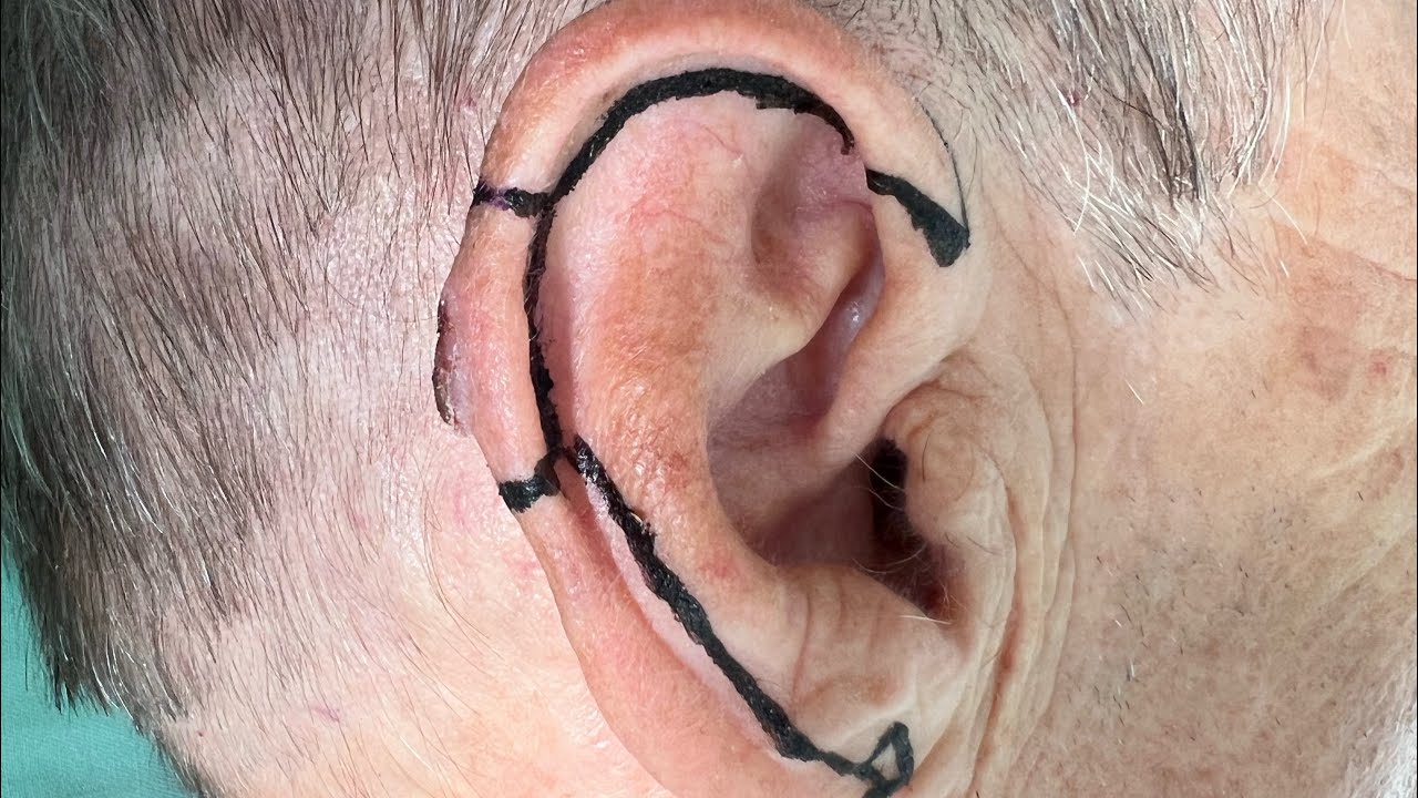 Antia-Buch flap for Ear reconstruction after skin cancer - YouTube