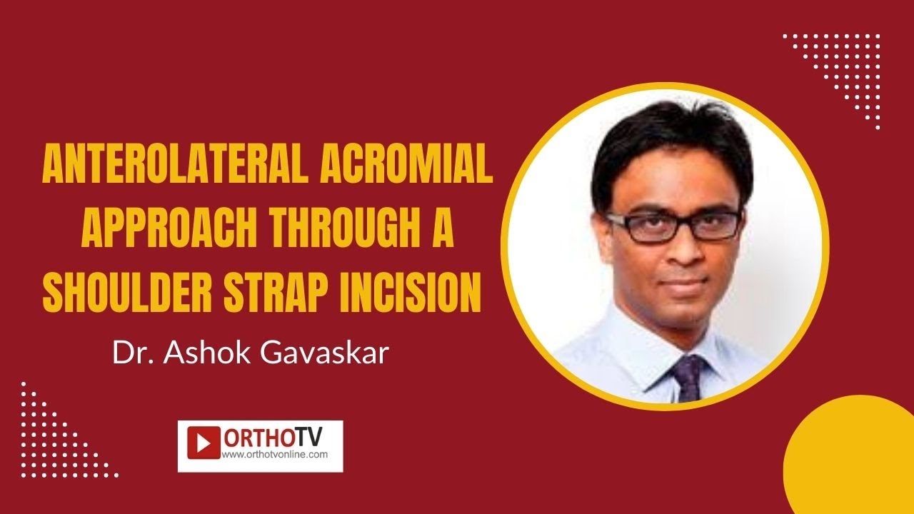 Anterolateral acromial approach through a shoulder strap incision - Dr ...