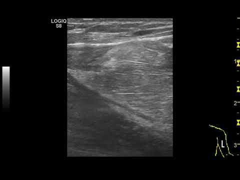 ROTURA DE BICEPS BRAQUIAL. SIGNO DE POPEYE. ECOGRAFIA DE BRAZO. - YouTube