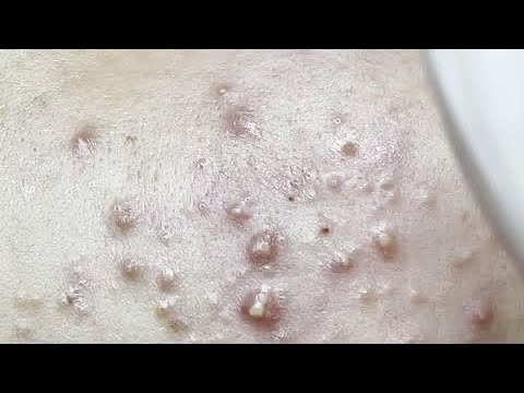Blackhead Removal With Sac Dep Spa @110261 #spa - YouTube