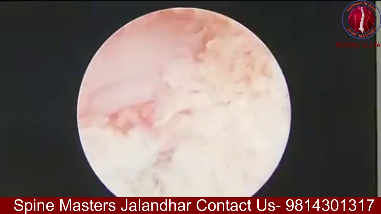 Spine Masters Jalandhar -Stitchless Spine Surgery - Dr. Pankaj Trivedi ...