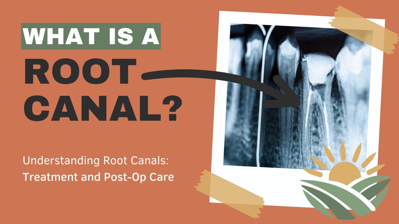 What is a Root Canal? Understanding Dental Root Canals: Treatment and ...