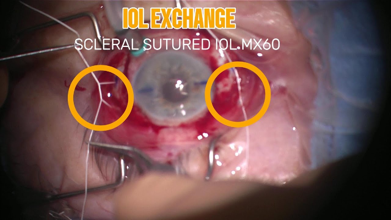 IOL Explantation with MX60 Secondary Sutured IOL - YouTube