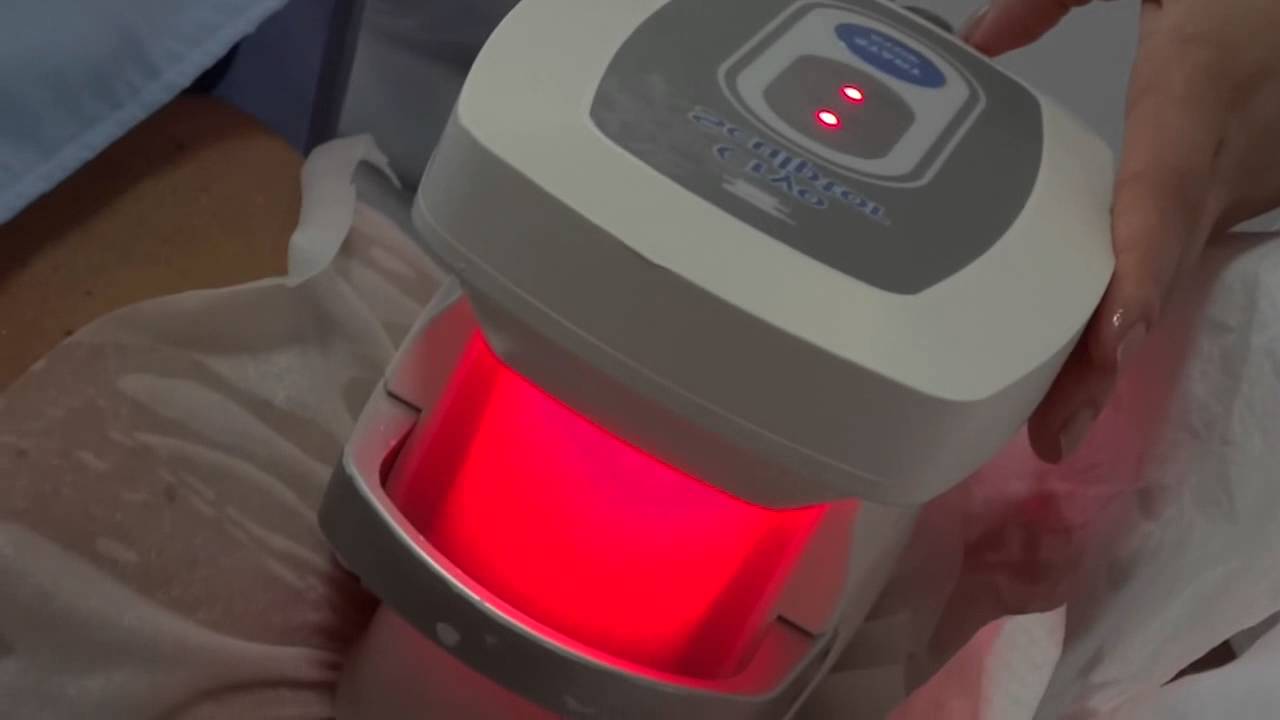 Como é uma sessão de criolipólise? - YouTube