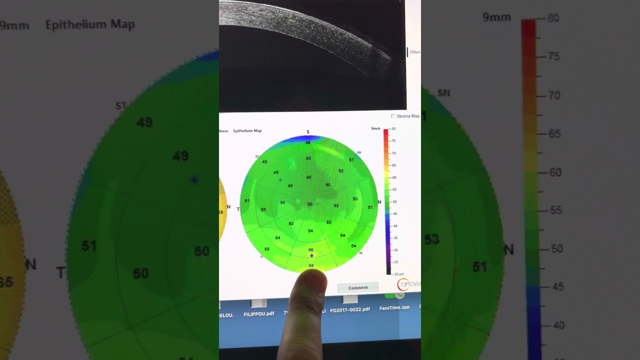Keratoconus? Careful evaluation of Pentacam and Optovue epithelial ...
