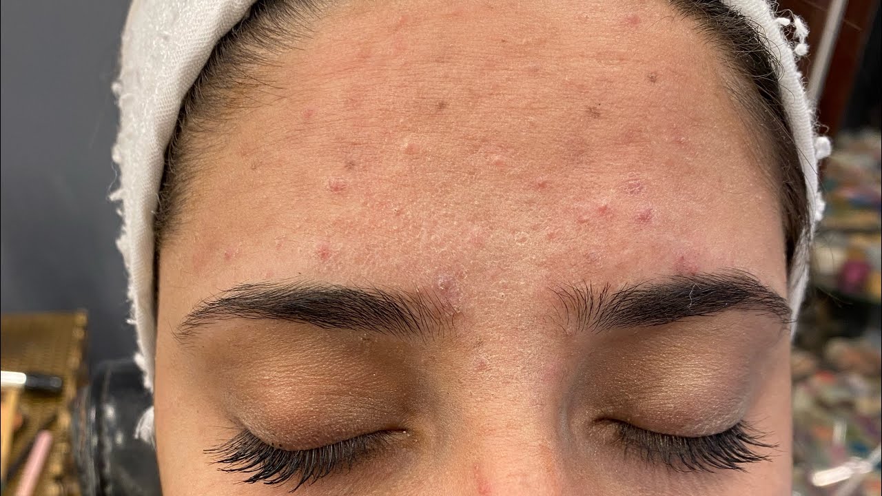 How to cover Acne | Hide Acne | full Coverage Acne makeup tutorial ...