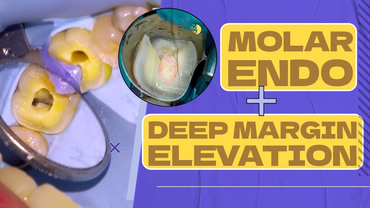 [102] FULL PROCEDURE - Live Root Canal with Deep Margin Elevation - YouTube