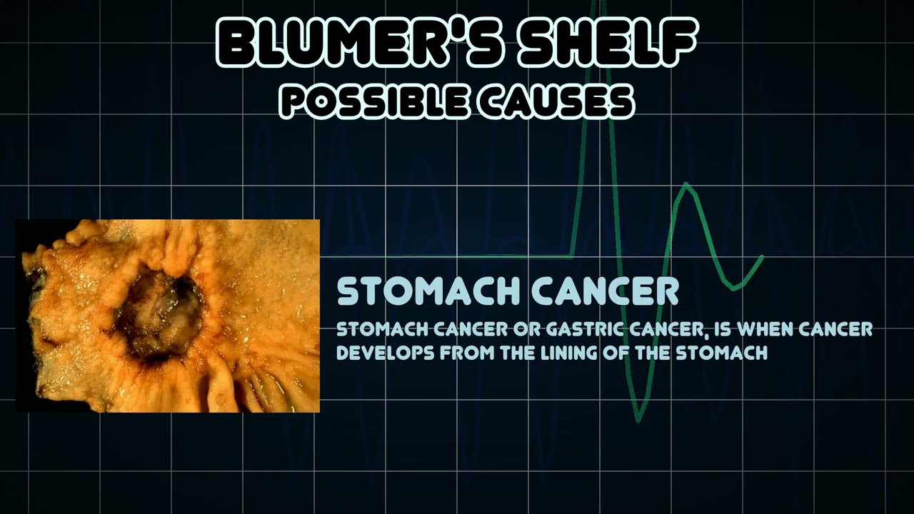 Blumer's shelf (Medical Symptom) - YouTube