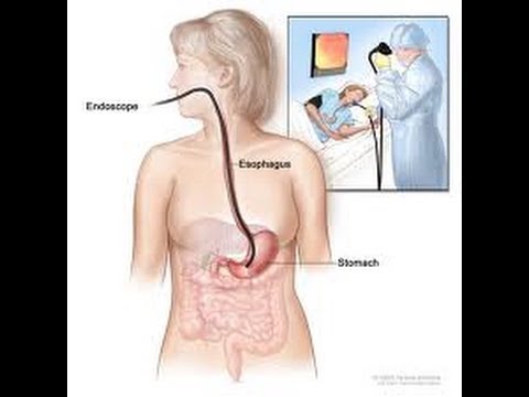 What is an Upper Endoscopy? | Los Angeles Endoscopy - YouTube