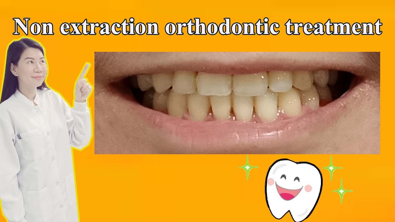 non extraction orthodontic treatment - YouTube