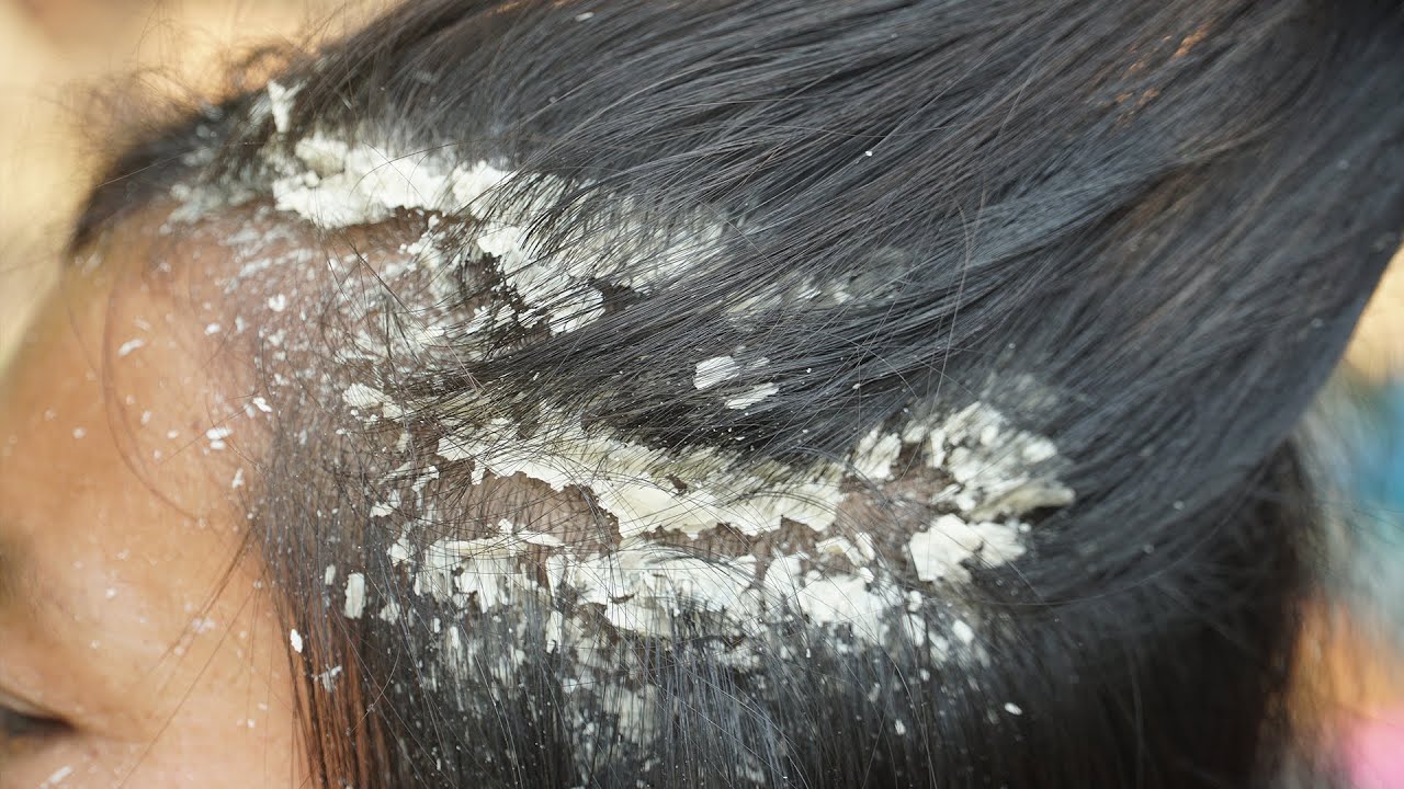 Deep Scalp Scratch — Thick Flake Layers Releasing Instantly #559 - YouTube