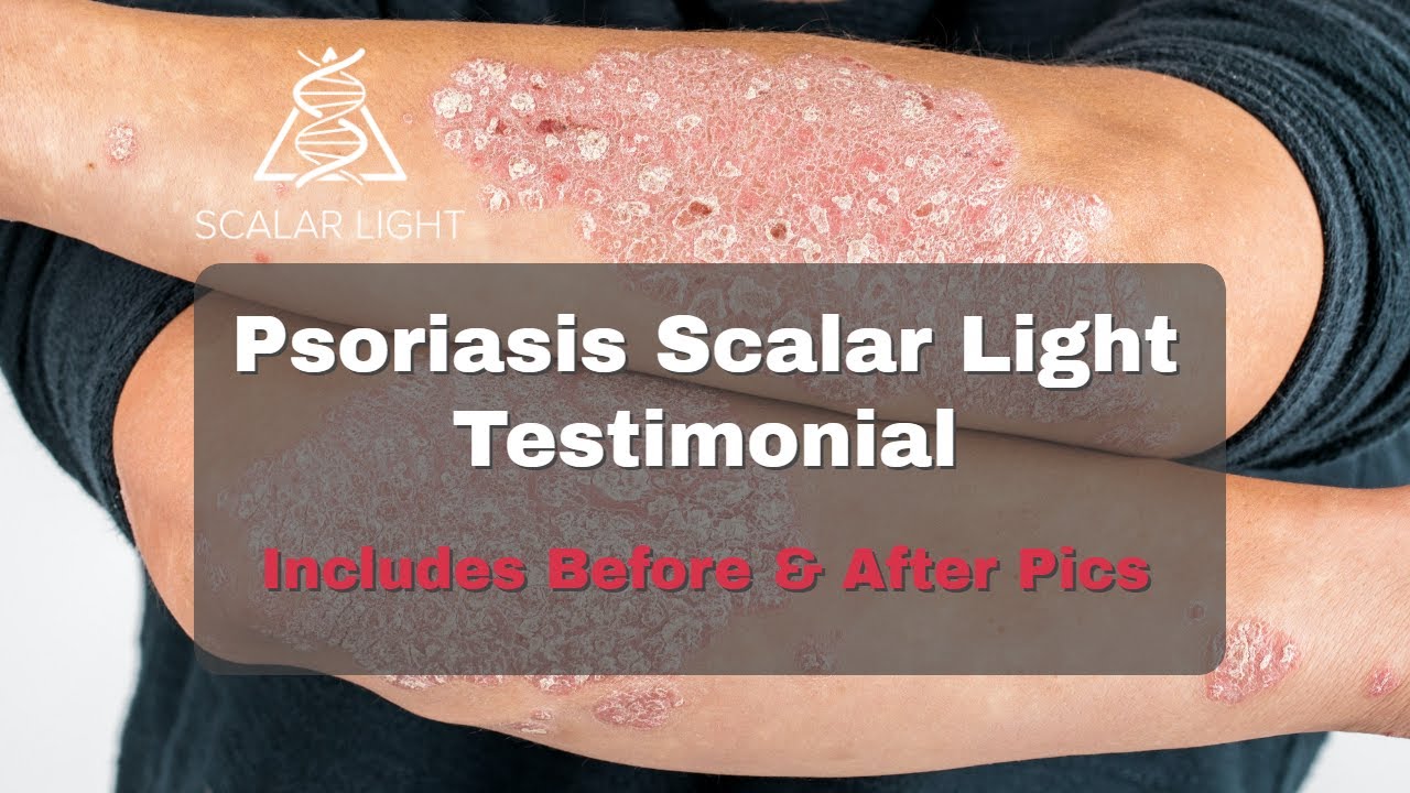 Psoriasis Scalar Light Testimonial - Includes Before & After Pics - YouTube