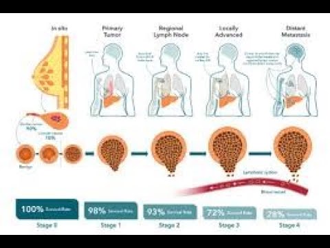 General Model For Breast Carcinogenesis (Breast Cancer0; Initiation, Promotion, Progression