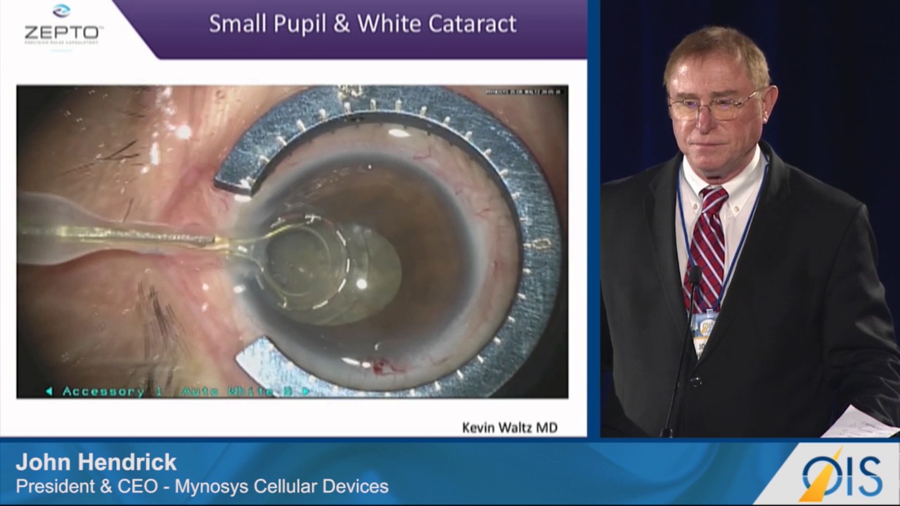 Mynosys Cellular Devices Eyes An Ideal Capsulotomy (OIS@AAO 2016) - YouTube