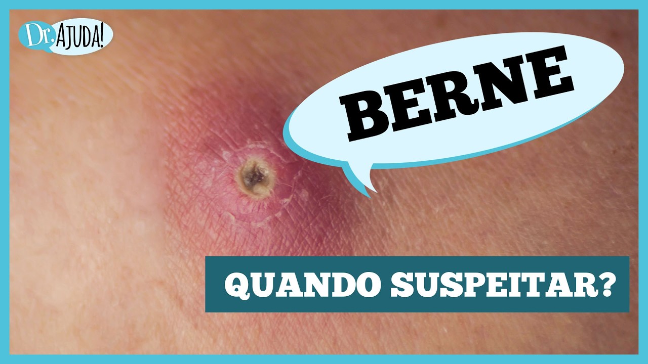 BERNE: larva sob a pele, dor e inflamação - YouTube