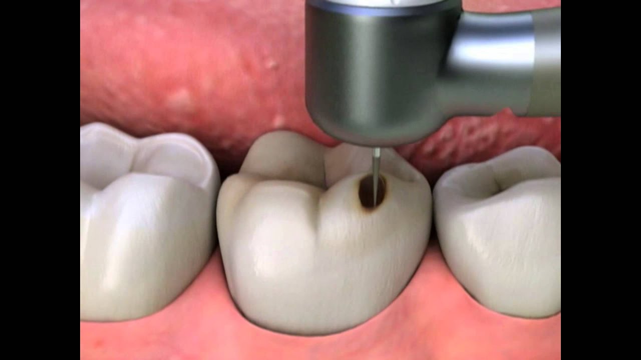 Resin Indirect Inlays or Onlays | Lake Merritt Dental, Oakland, CA ...