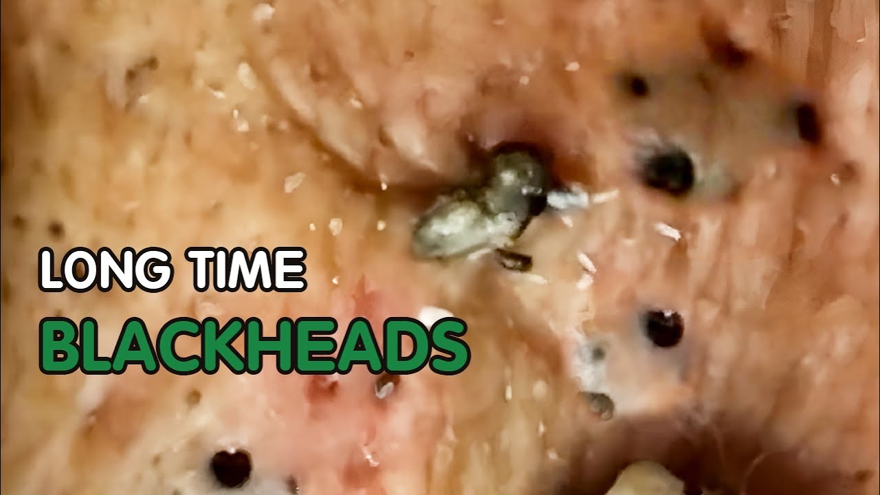Blackheads Removal, Acne Hidden For a Long Time - YouTube