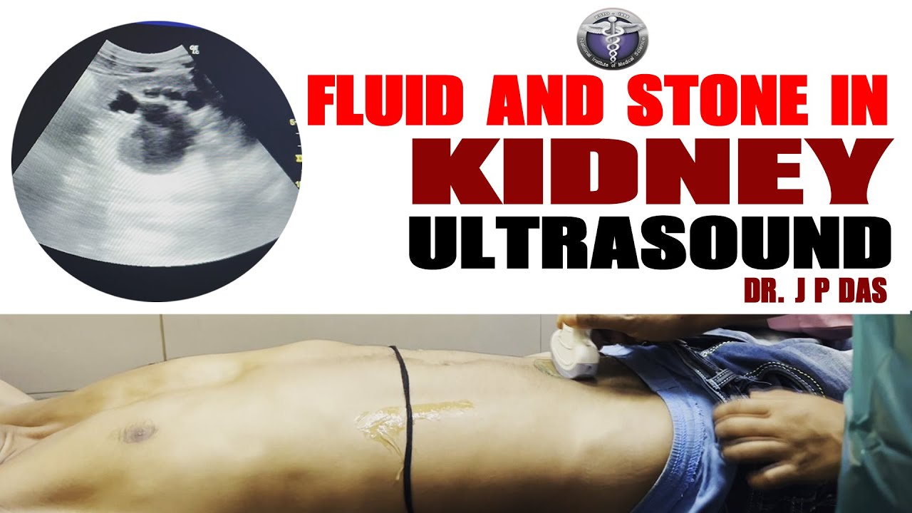 FLUID AND STONE IN KIDNEY | ULTRASOUND | DR. J P DAS - YouTube