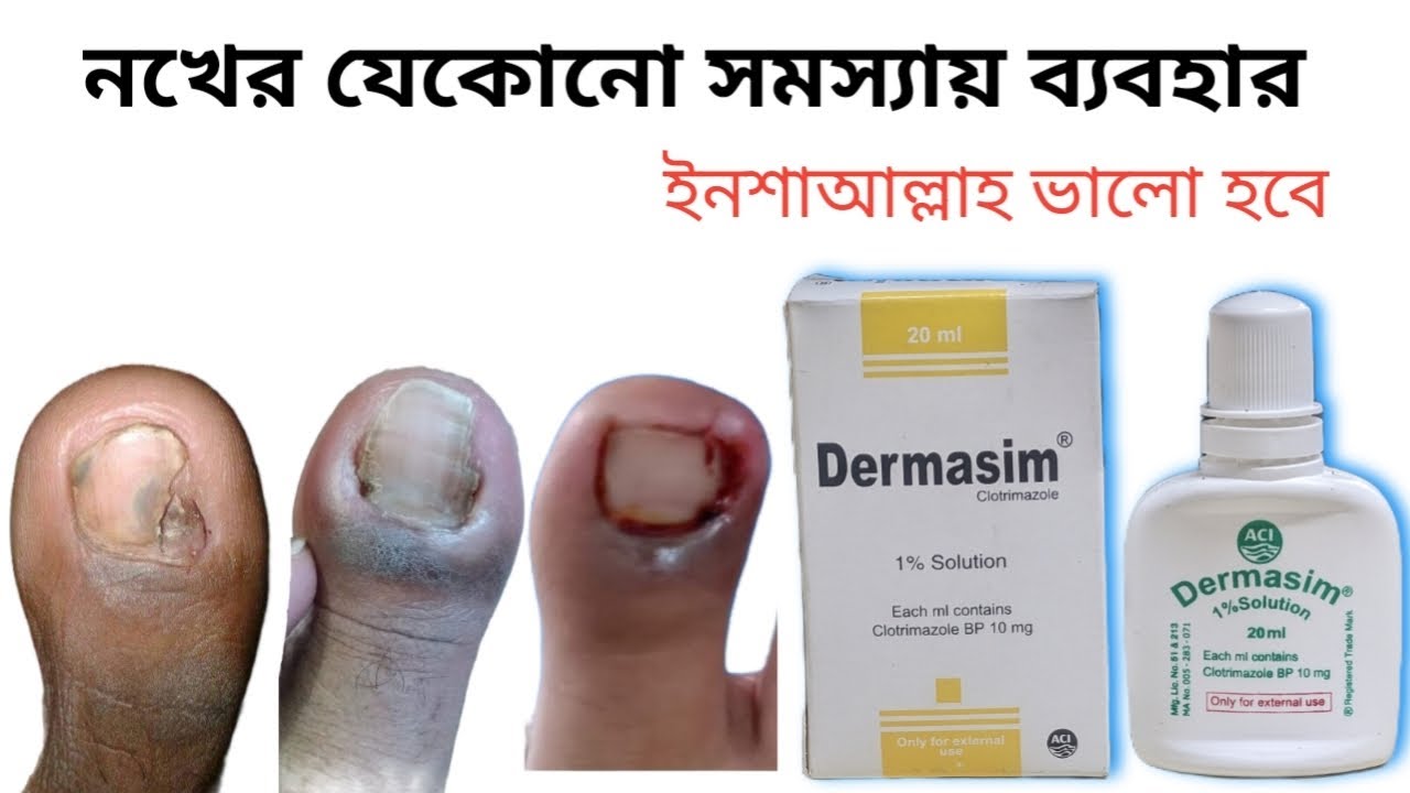 Dermasim এর কাজ । ব্যবহার নিয়ম । নখ কুনির চিকিৎসায় কার্যকরী লোশন ...